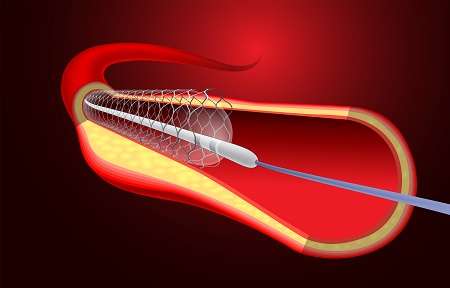 Cost of Angioplasty and Stent | Stent Cost in Mumbai